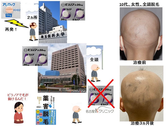 アレロックで再発、ビラノアで全部脱毛した患者さん、3ヵ月で産毛！ 患者様からの声・メディア掲載・クリニックからのお知らせ 名古屋kクリニック